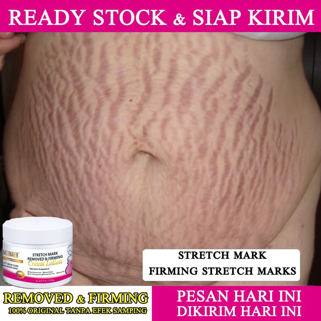 Remove Stretch Marks Cream strech mark cream Scar Removal Cream ...