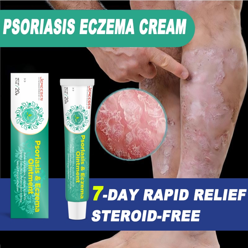 Jemeesen Ekzema Psoriasis 100% Original Ubat Gatal Krim Treatment Of ...