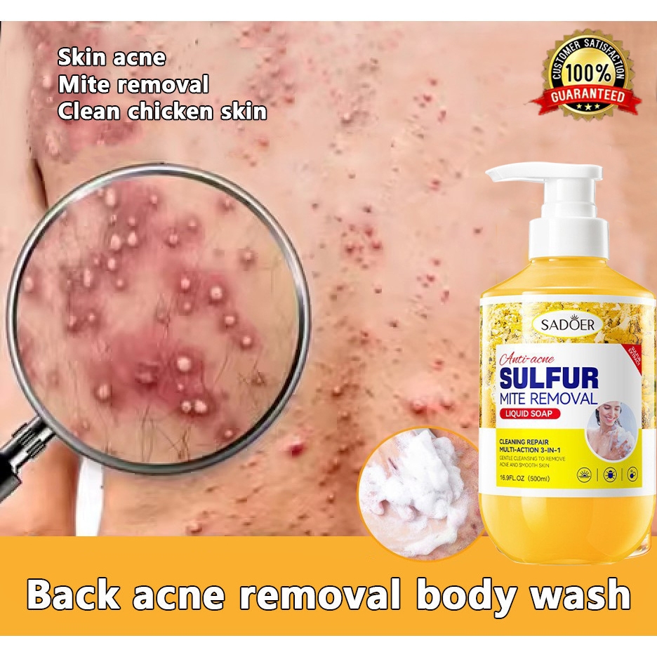 acne body wash Sulfur Acne Anti mite back acne body wash 500ml Eczema ...