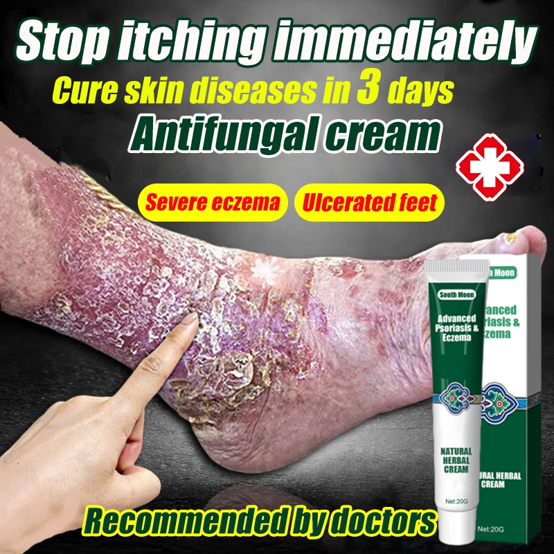 1minutes to relieve itching Antifungal cream Eczema cream Relieve ...