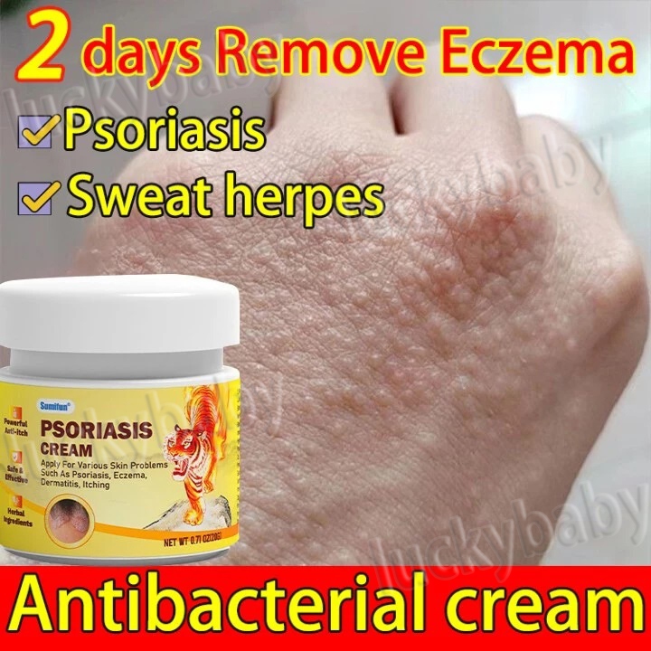 Psoriasis Cream Antifungal cream Eczema cream Cream gatal kulit 20g ...