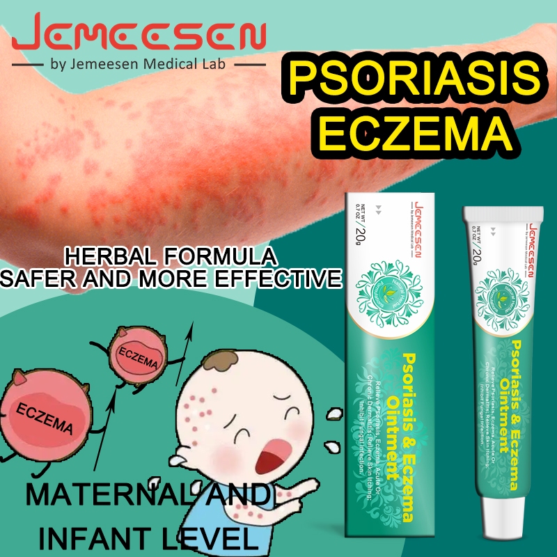 Jemeesen Eczema Cream 100% Effective Ubat Gatal Kulit Original Krim ...