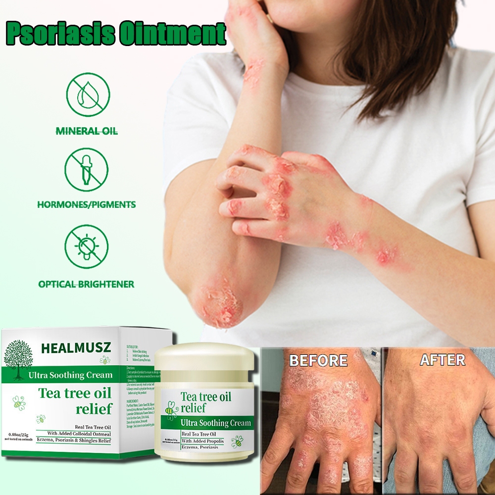Psoriasis Cream Antifungal cream Eczema cream Anti-itch cream Wetren ...