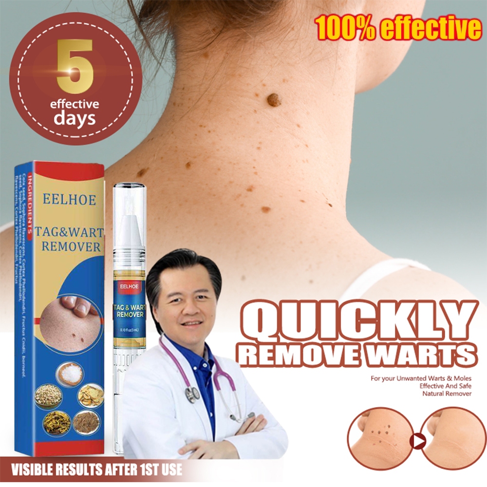 Warts Remover Original Kasoy Oil Warts Remover Warts And Skin Tags ...