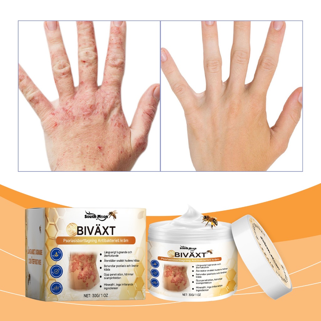 South Moon Psoriasis Eczematoid Ointment Treat Dermatitis Urticaria ...