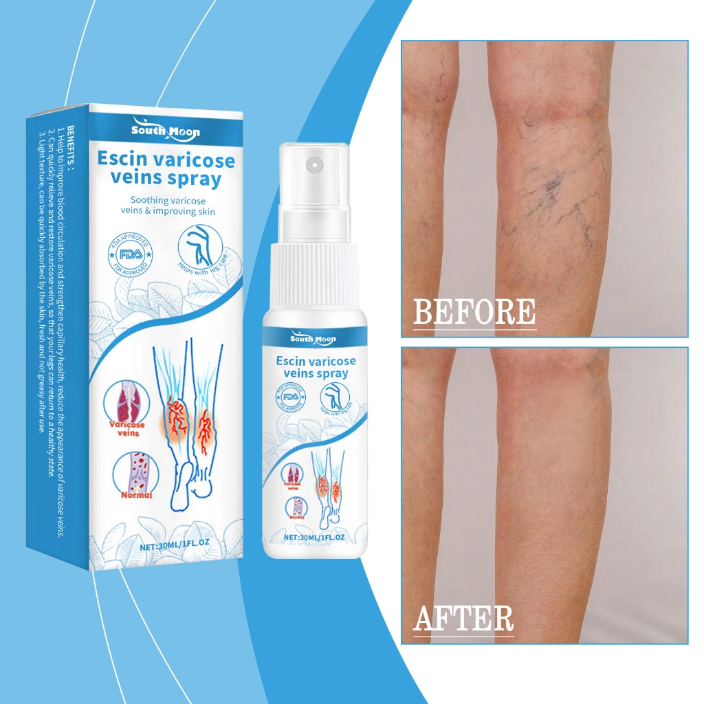South Moon Varicose Vein Spray Vasculitis Phlebitis Removal Vessel ...