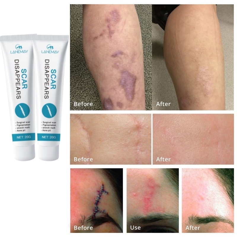 Scar Removal Cream Black Scar Removal Cream, Old Scars, Scar Scabs ...