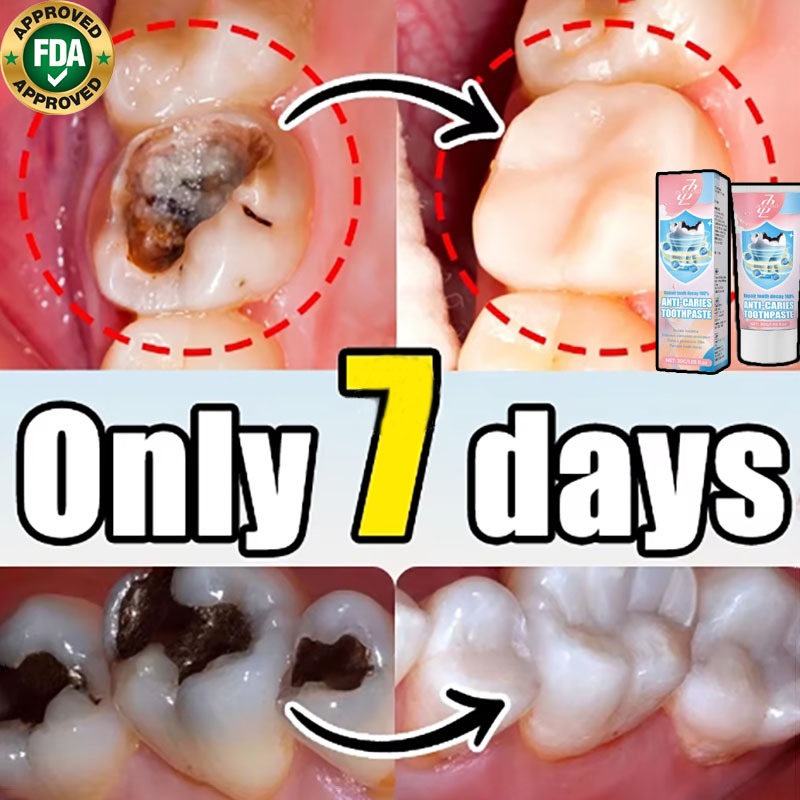 Anti-caries toothpaste, deep cleaning, protect teeth, prevent caries ...