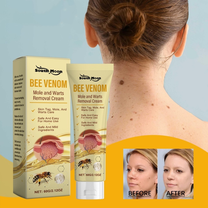 Skin Tags Remover tahi lalat remover 60g Treat Flat Warts and other ...