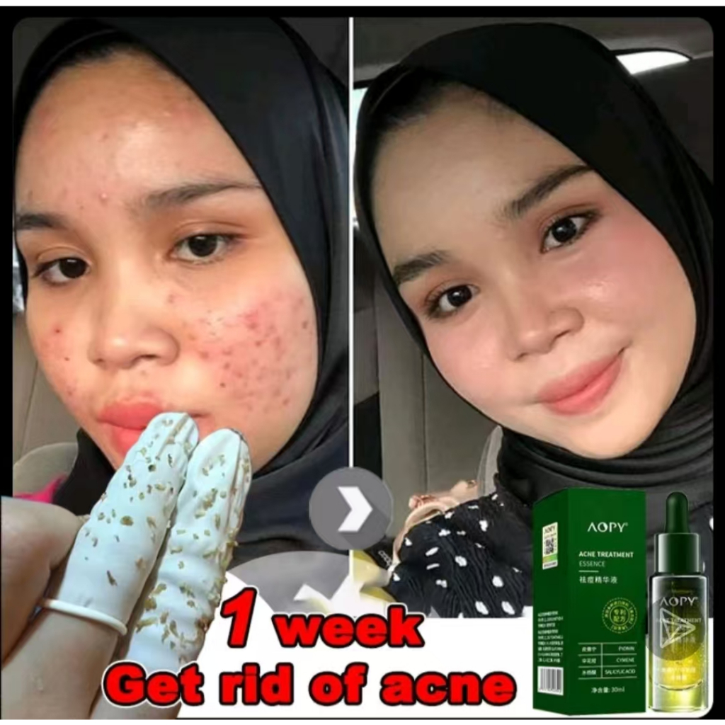 AOPY Acne Removing essence Facial Decaying Acne, Acne Closing, Acne ...