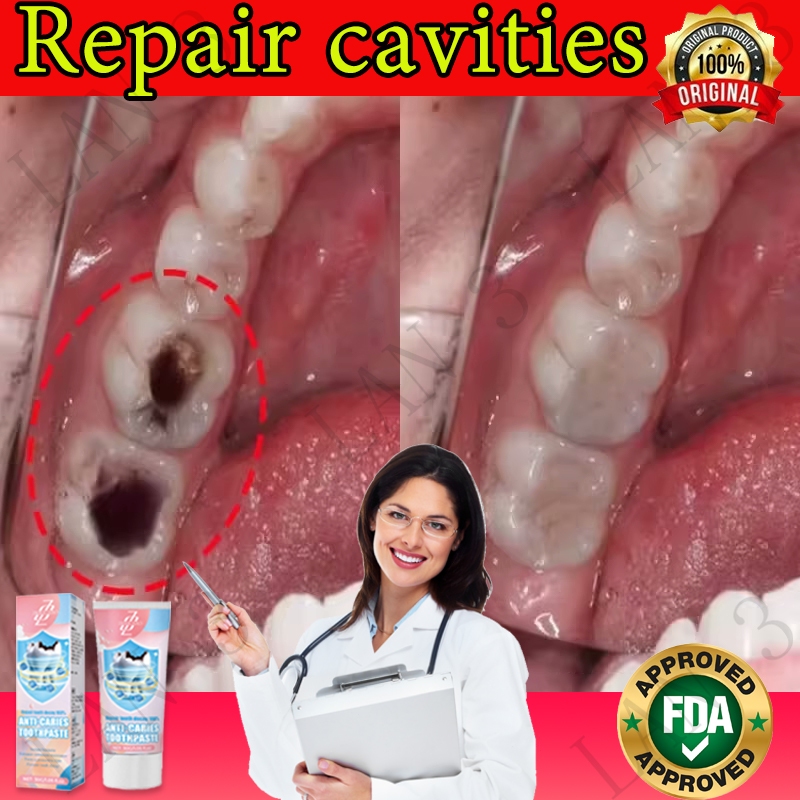 Anti-caries toothpaste, teeth repair toothpaste Tooth Decay Repair deep ...