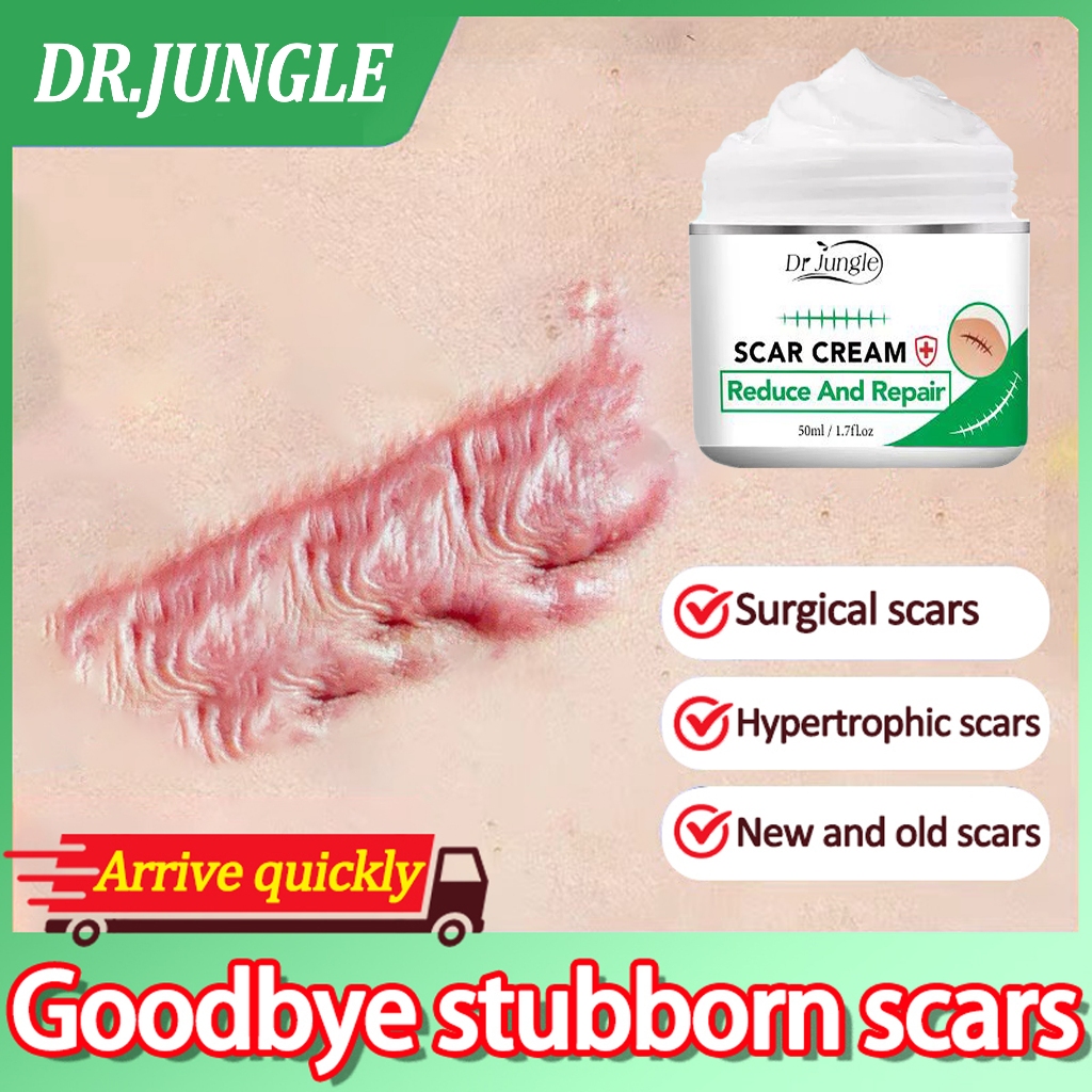 Local Sellers Scar removal cream, scar cream can be reused. Scar ...