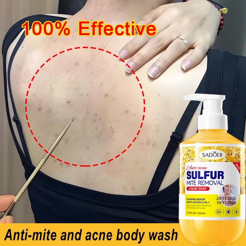 Sulfur mite removal liquid fertilizer soap oil control acne ...