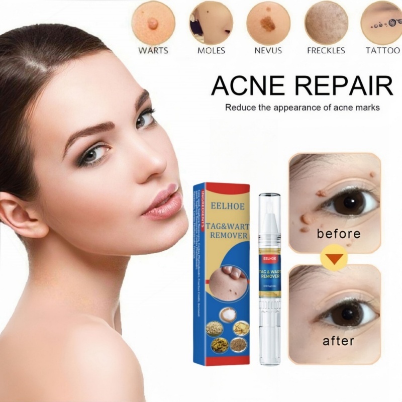 Ubat ketuat Tahi lalat remover Skin tag remover Buang tahi lalat dan ...