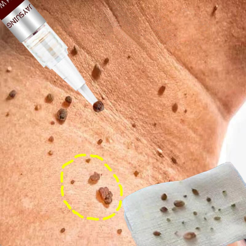Warts Flat Eliminate Wart Pen 20gWart Liquid Hand Foot Warts Remove ...