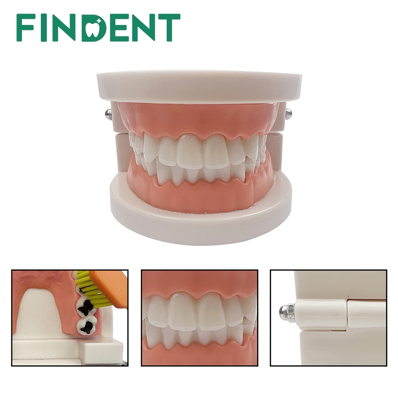 1Pcs Dental Education Model With Caries Tooth Standard Teeth Model ...