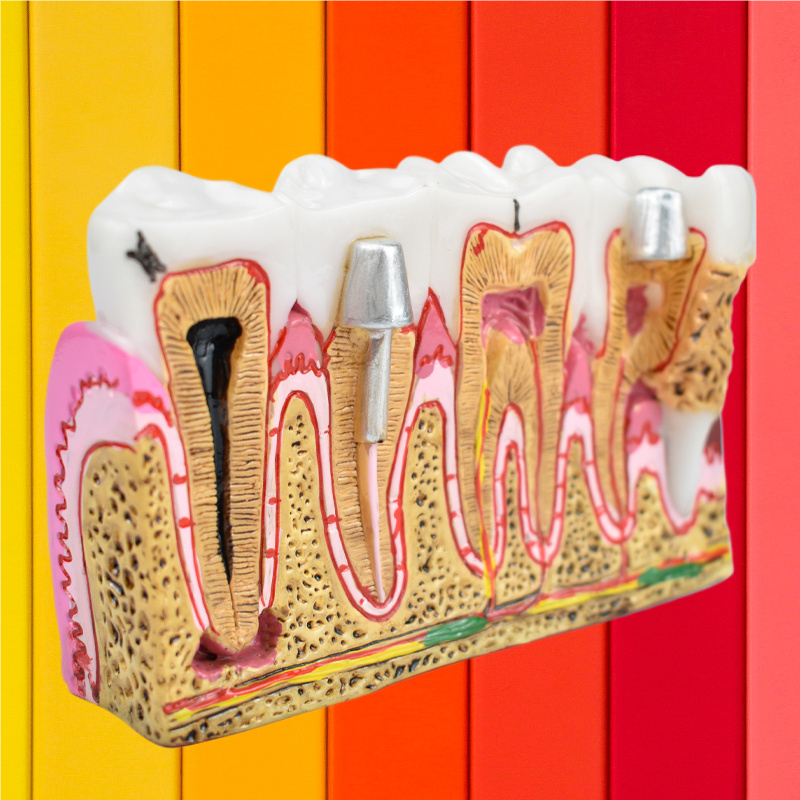 1PCS/Dental Tooth Model Caries Anatomy Model Comprehensive Pathology ...