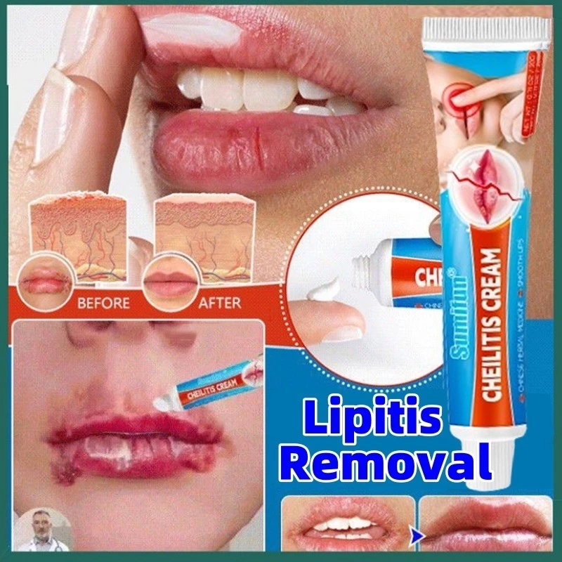 Cheilitis Lip Care,Lip Mask,Cheilitis Treatment Cream,Lips Cream Lips ...