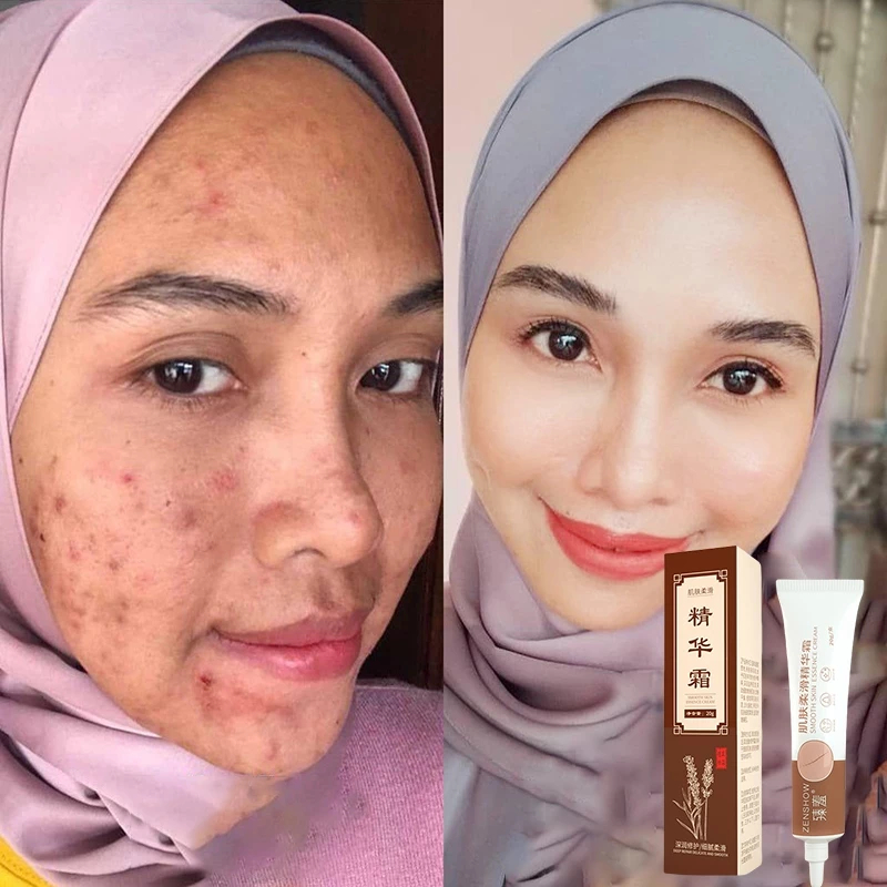 Acne Cream acne spot treatment keloid scar remover acne scar treatment ...