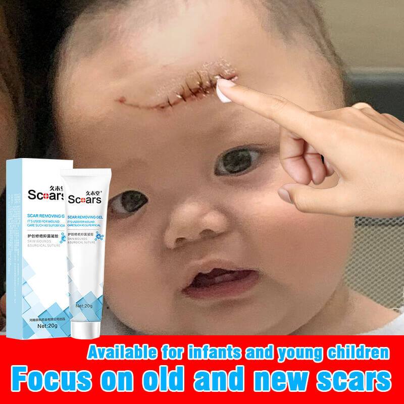 Scar cream baby scar gel Scar Removal Cream medicine to remove black ...