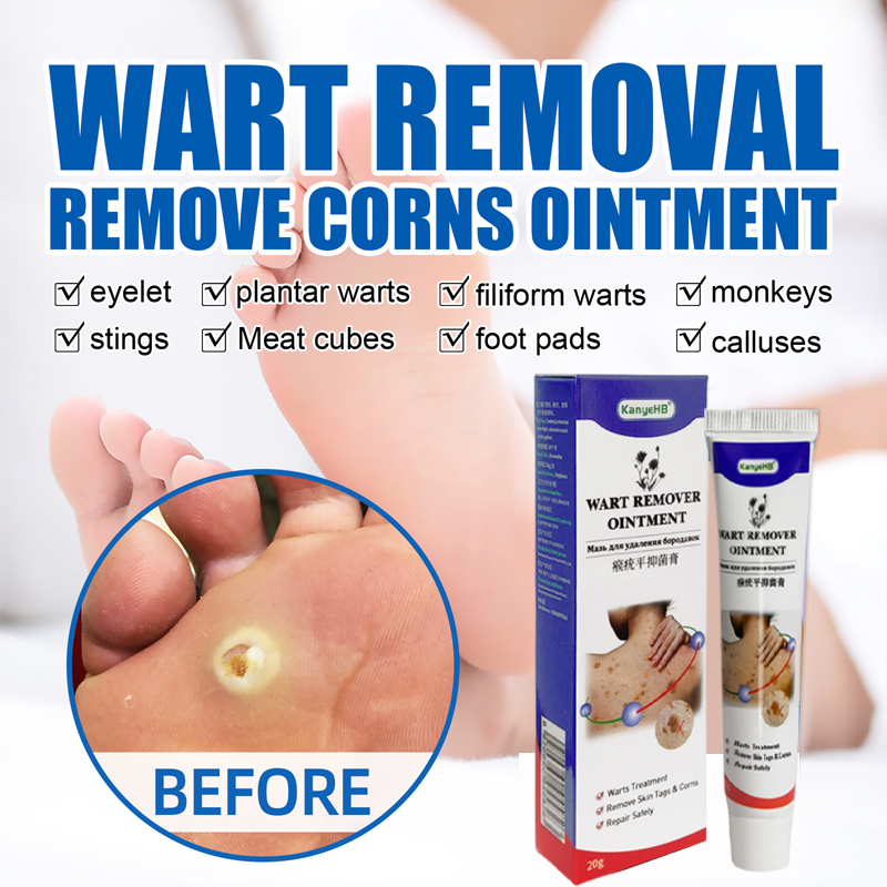 Remove wart ointment 20g clavus verruca eyelet plantar warts filiform warts Skin wart | Shopee ...
