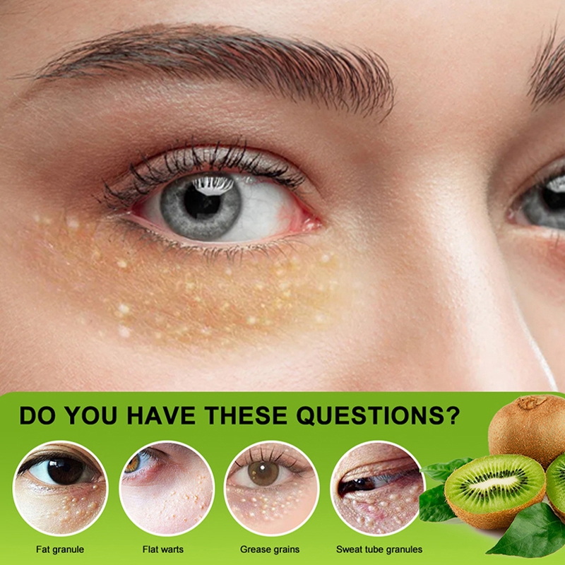 Removing Fat Granules Cream 20g Eye fat particles.fat granules ...