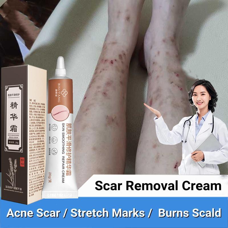 Effective Scar Removal Cream Scar gel Acne Scar Treatment Cream 20g to ...