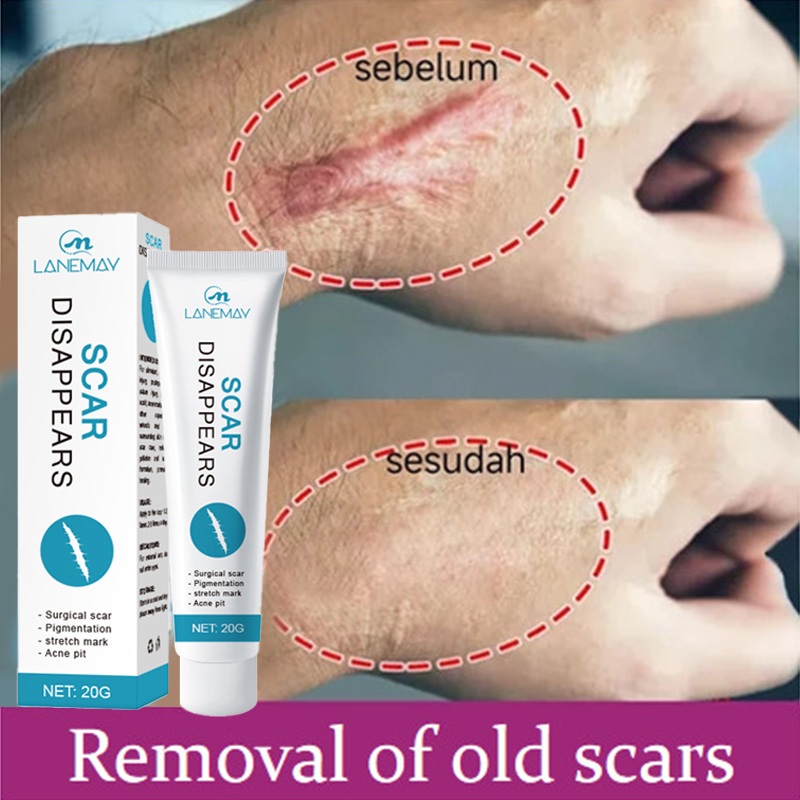 scar removal cream repair old scars keloid scar remover krim hilangkan ...