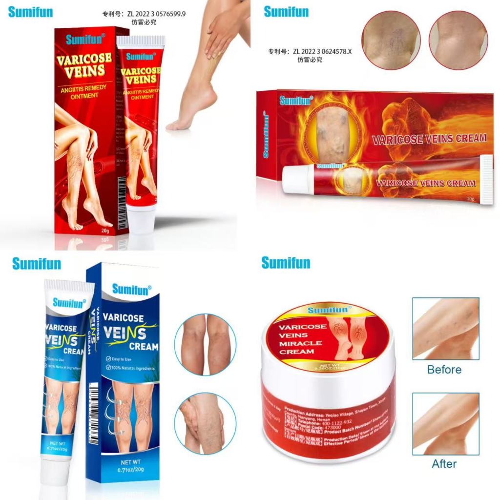 New Varicose Vein Treatment Cream Vasculitis Phlebitis Spider Pain ...