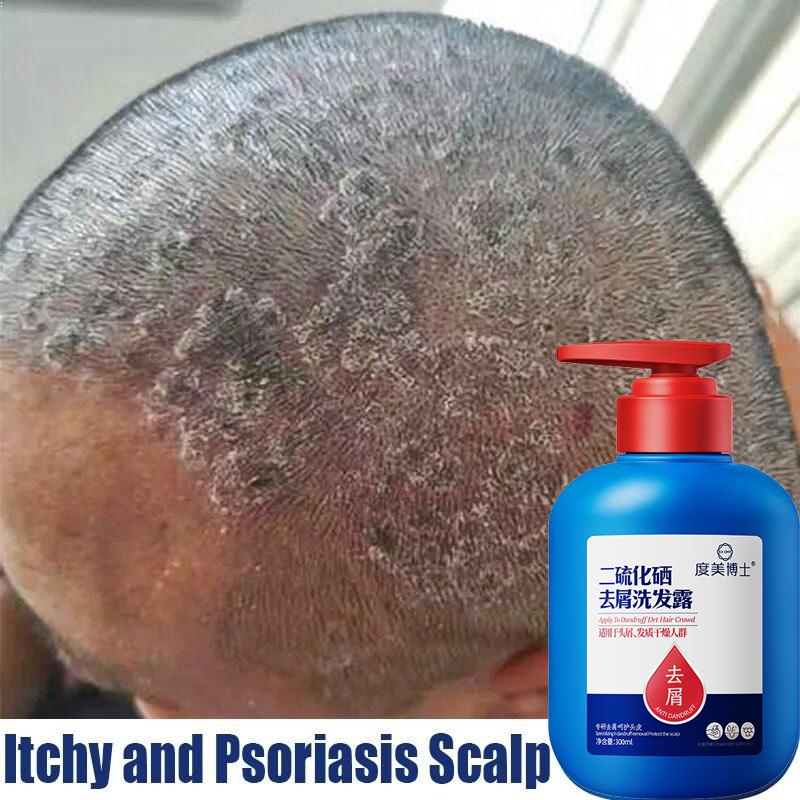 Original Selenium Disulfide Anti-Dandruff Shampoo anti dandruff shampoo ...