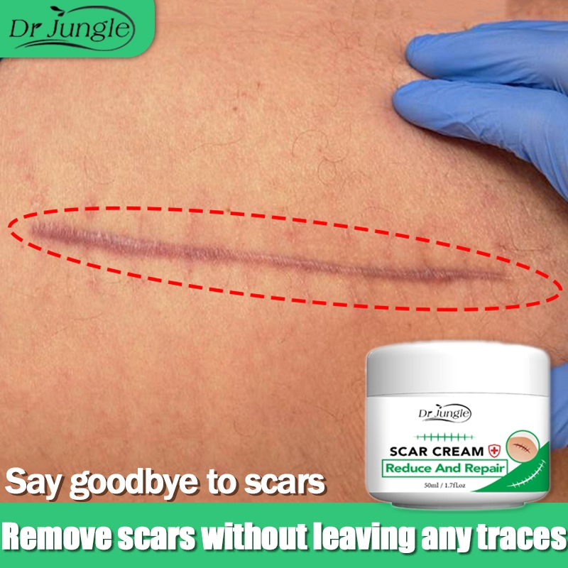 【Fast Scar Fading】DR.JUNGLE Scar Cream | Reduces Scars, Burns, Acne ...