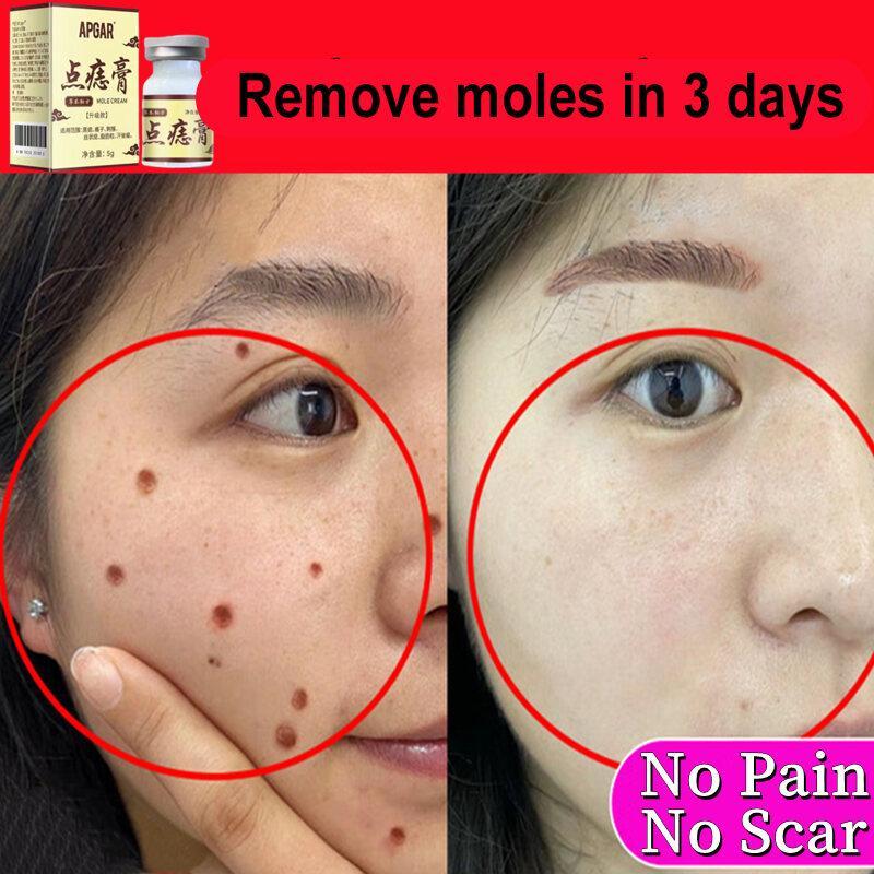 Mole cream, wart removal, original cream, common wart removal, wart ...