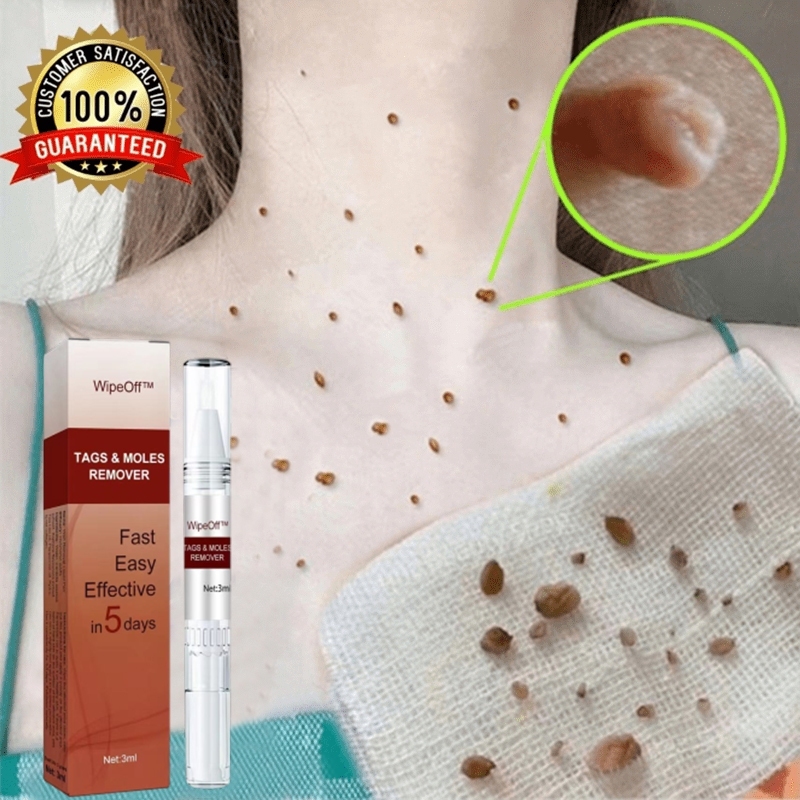 Ubat Ketuat Tahi lalat Skin Tag remover Pen Buang tahi lalat dan kutil ...