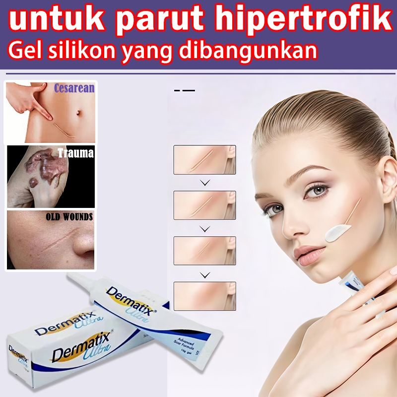 dermatix ultra scar removal cream hilangkan parut jerawat ubat parut ...