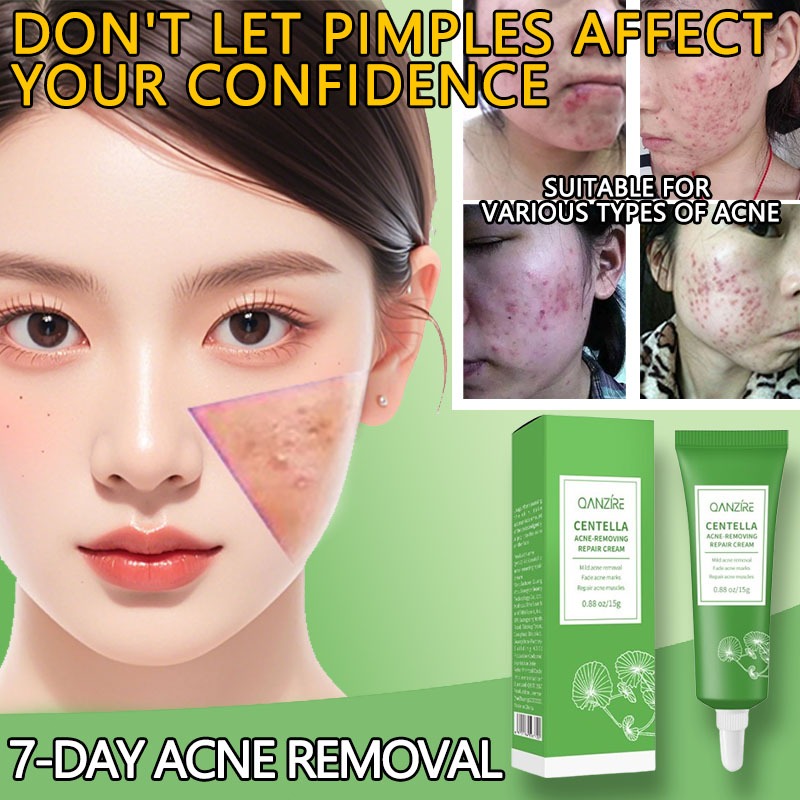 Effective acne removal 99.99% Acne cream Remove Blackhead Oil Control ...
