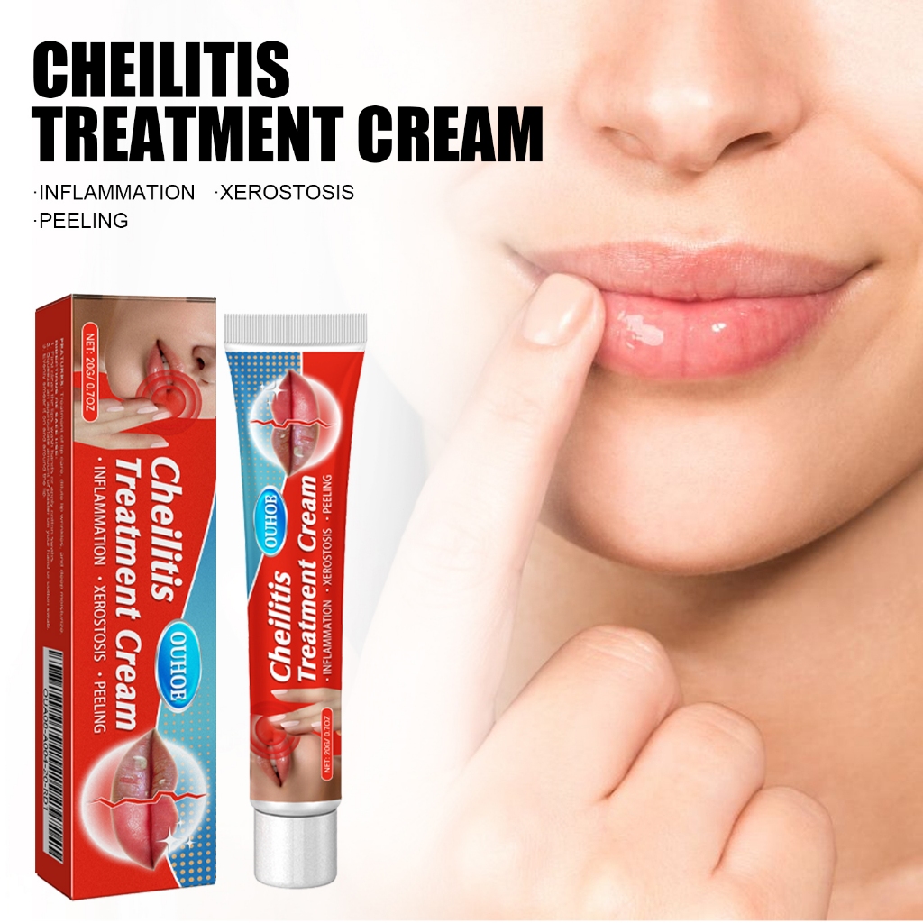 Cheilitis Treatment Cream Relieve Cheilitis Symptoms Repair Lip Cracks ...