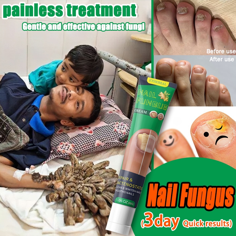 Anti Paronychia Relief cream Ingrown Toenail Anti Fungal Toe Nail ...