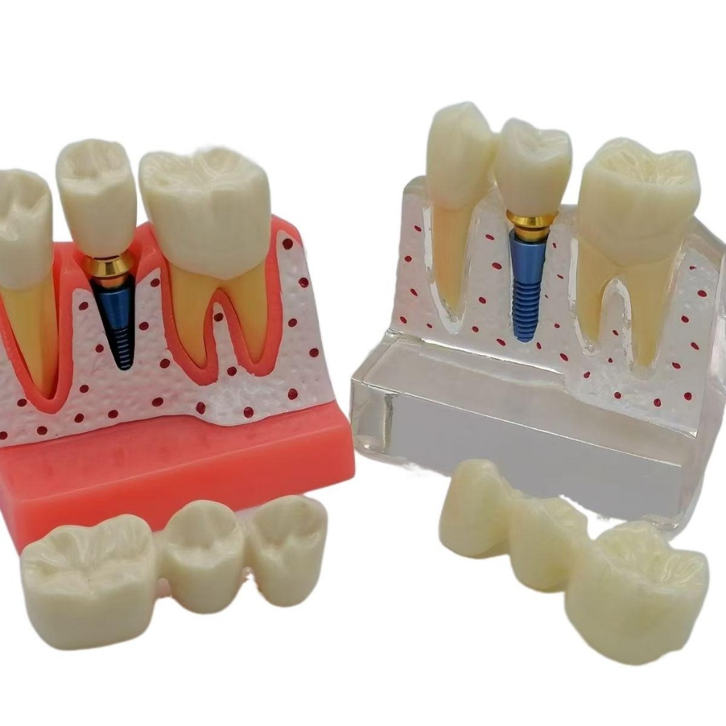 Dental Teach Crown Bridge Removable Model Porcelain Teeth Model Dental ...