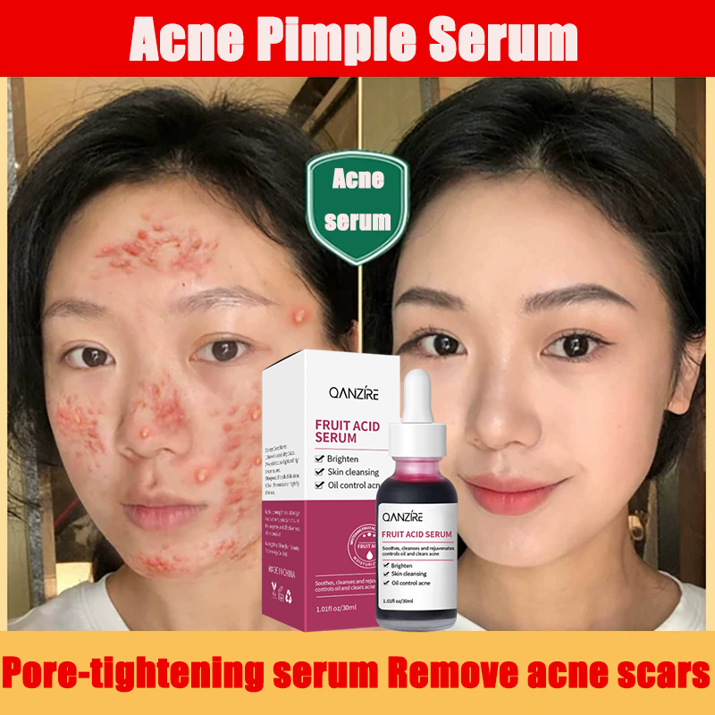 Acne serum 30ml Pore Shrinking serum Remove acne scars acne pits and ...