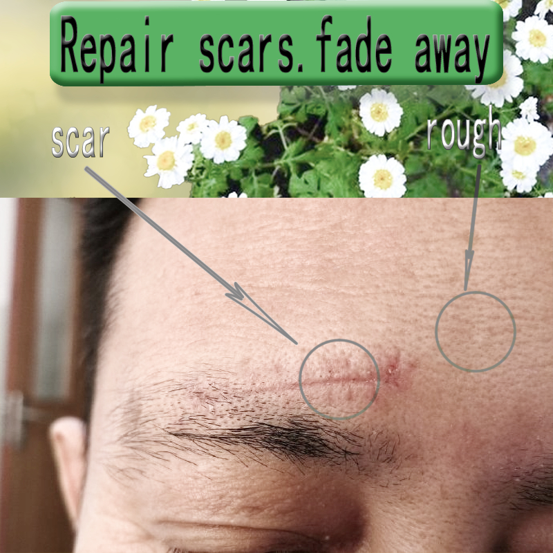 Scars repair essence cream 50G hypertrophic scar pitting scar lump scar ...