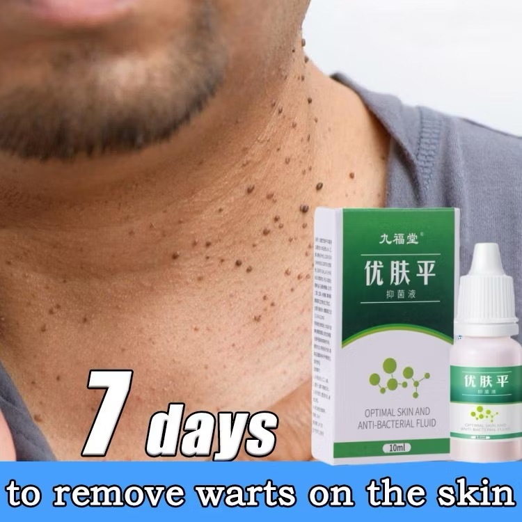 Ubat Ketuat Tapak Kaki Warts Removal Buang Kutil Corn and Calluse ...