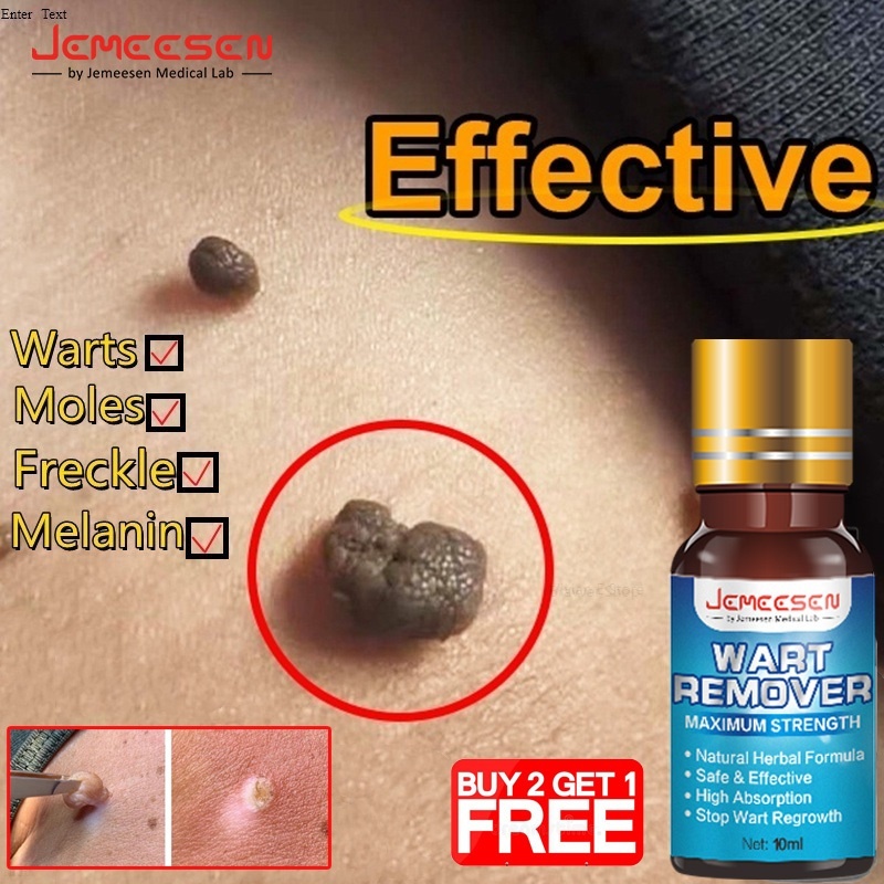 Jemeesen Wart Removal Body Warts Treatment Skin Tag Remover Blemish ...