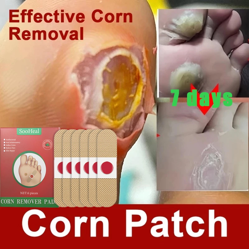 Corn Patch Removes South Moon Wart Hard Calluses Calluses Warts Hand ...
