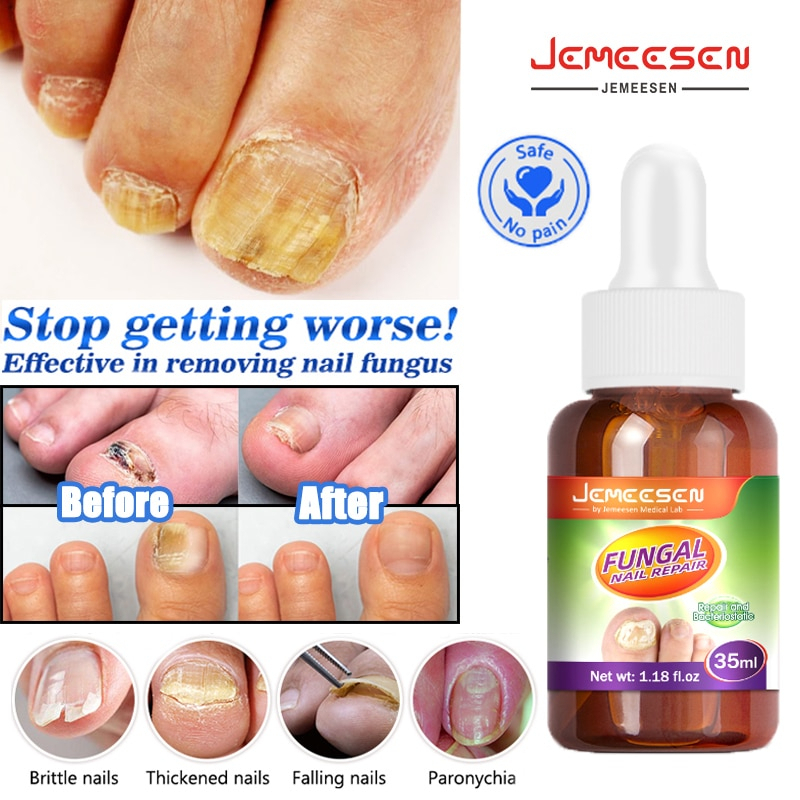 Jemeesen Nail Fungus Repair Treatmen Nail Repair Liquid Kuku Rosak ...