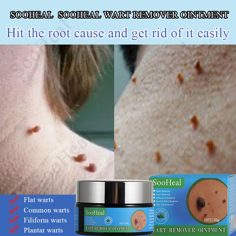 【SooHeal】wart remover skin tag remover mole remover 20g Safe and ...