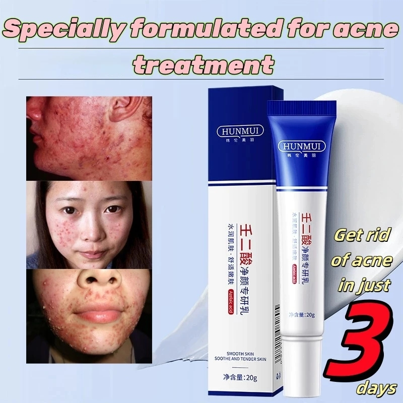 3 Days Fast Acne Treatment Acne Cream 20g Pimple Cream Acne Spot ...