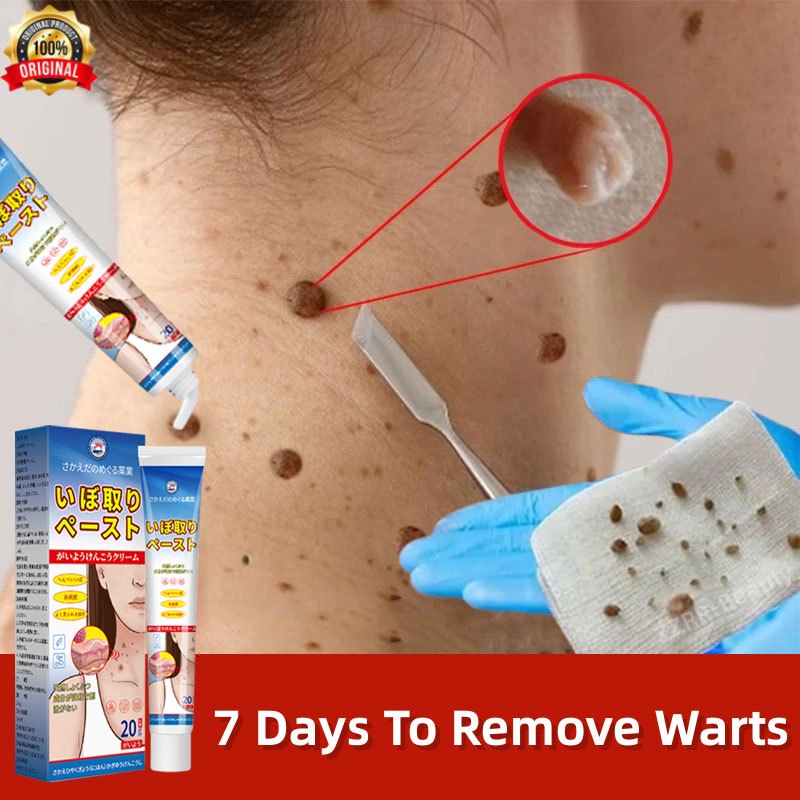 Wart Removal cream ubat kutil Removal tahi lalat remover Warts Remover ...