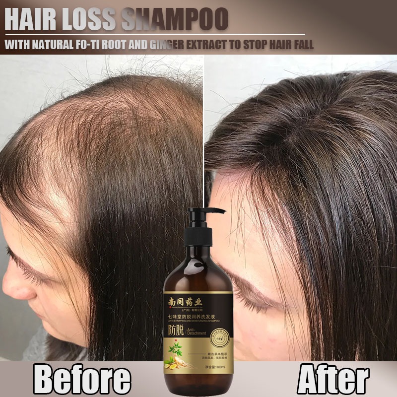 Hair Loss Shampoo anti hair fall shampoo hair loss shampoo 300ml ...