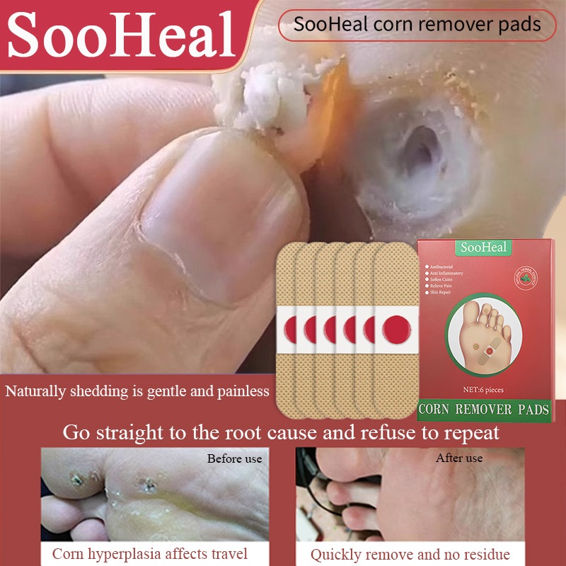 【SooHeal】Foot corn removal patch Wart Remover Patch Corn Plaster Ubat ...