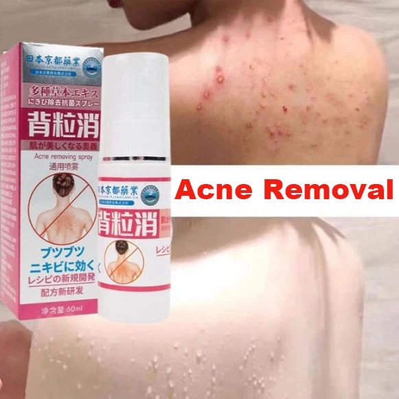 🔥[Rapid Results] 🔥Japan KYOTO KYOTO Back Particles Eliminate Acne Care ...